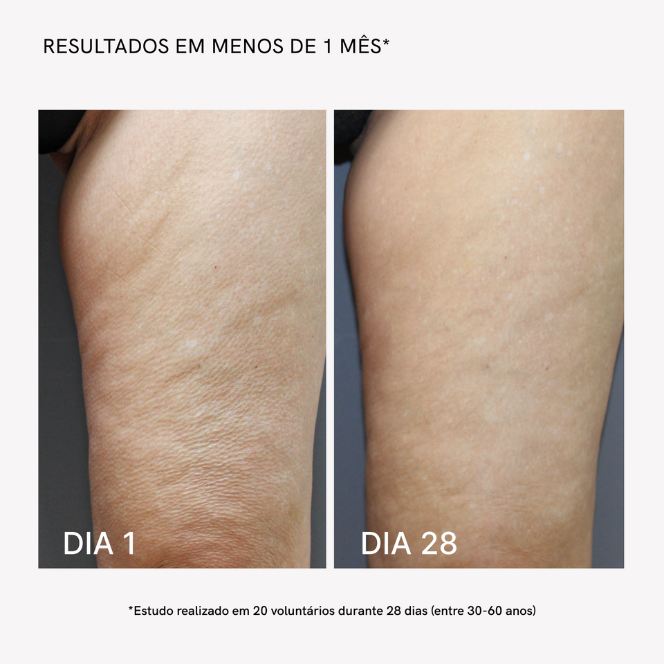 Firmeza Corporal por Radiofrequência | Tratamento corporal domiciliar ...