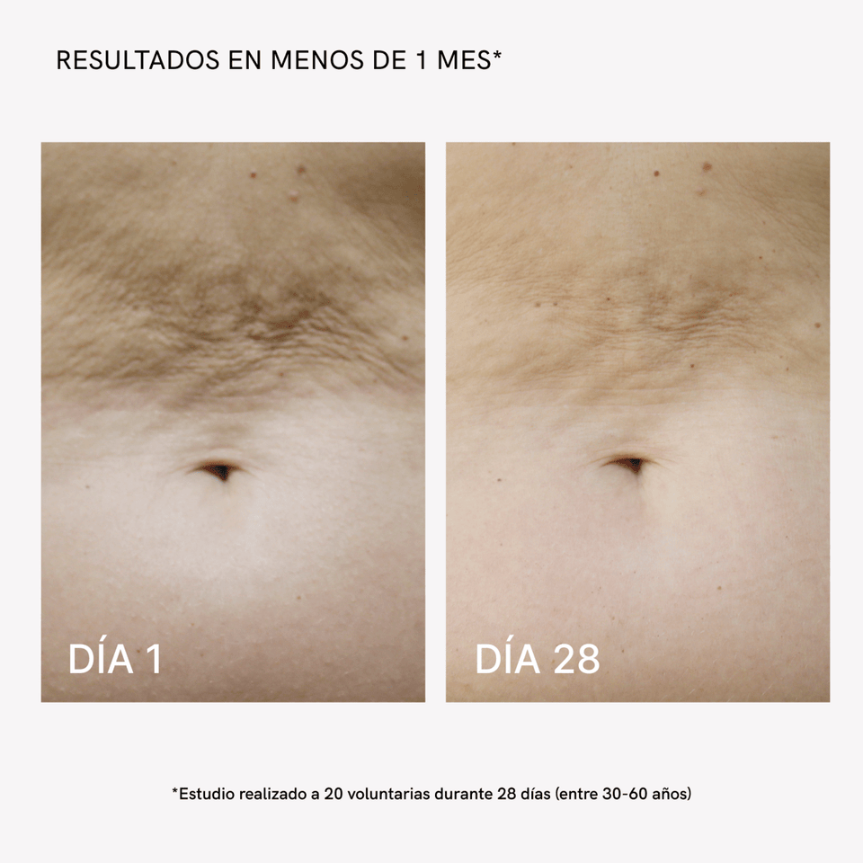 RF Tratamiento Radiofrecuencia Flacidez Corporal en casa – Masderm ...